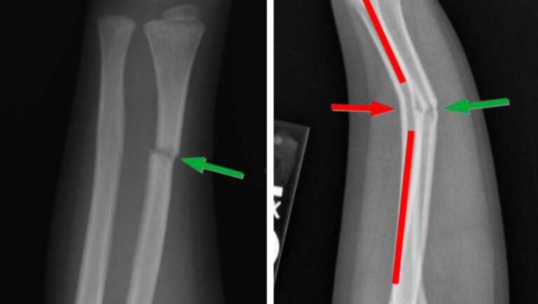 Patient guide – awareness and importance of pain associated with bone ...