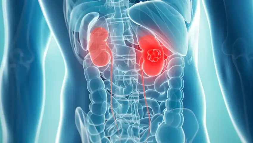 Kidney Cancer – All You Need to Know and How We Can Help - Dr. Pratik Patil